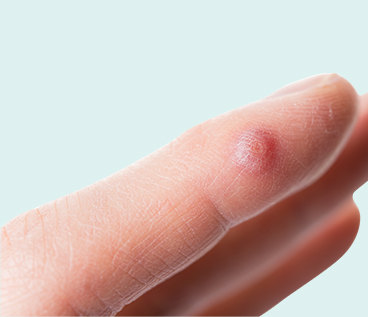 Wart Removal Treatment: Cost, Procedure & Results