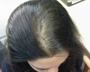Syphilis Hair Loss - Know Its Causes And Treatments