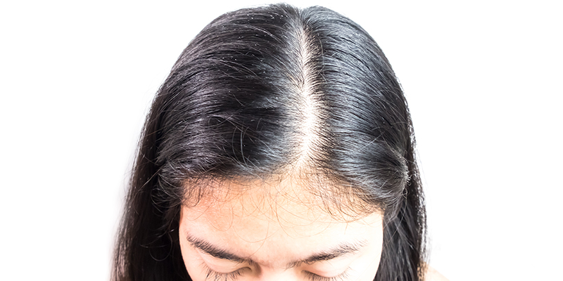 Buildup Hardened Sebum On Scalp Art valley