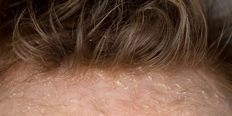 How To Remove Excess Sebum From Scalp: Causes And Tips