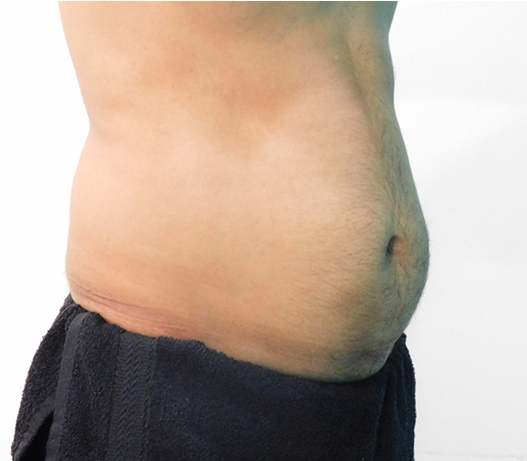 Before & After Results Of Inch Loss Treatment