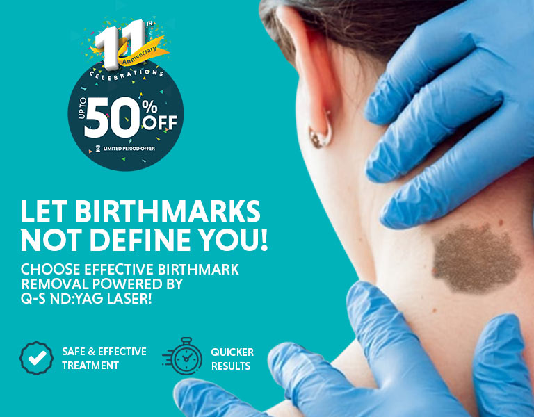 Birthmarks: Types, Causes And Treatment Options