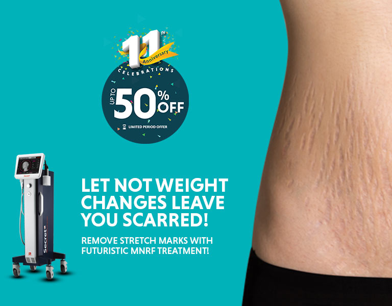 Stretch Marks: Causes, Types And Management Options