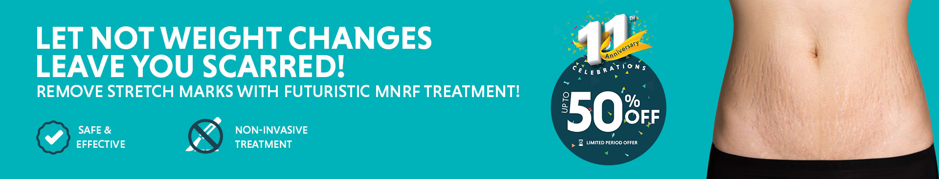 Stretch Marks: Causes, Types And Management Options