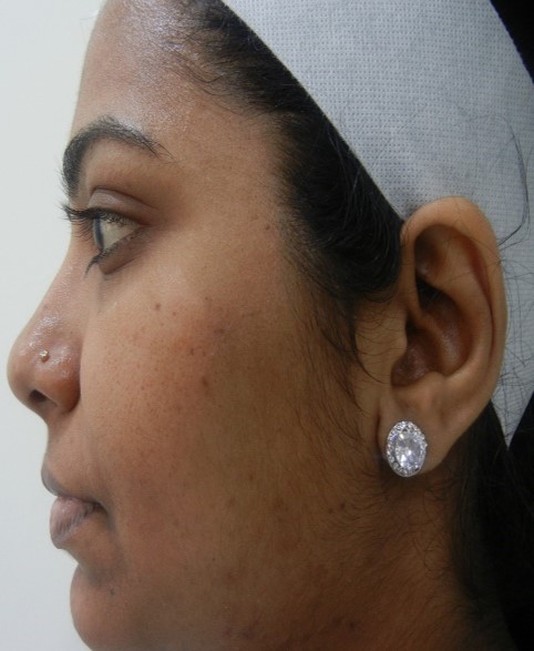 Laser Skin Lightening Treatment - Skin Whitening Treatment Clinics