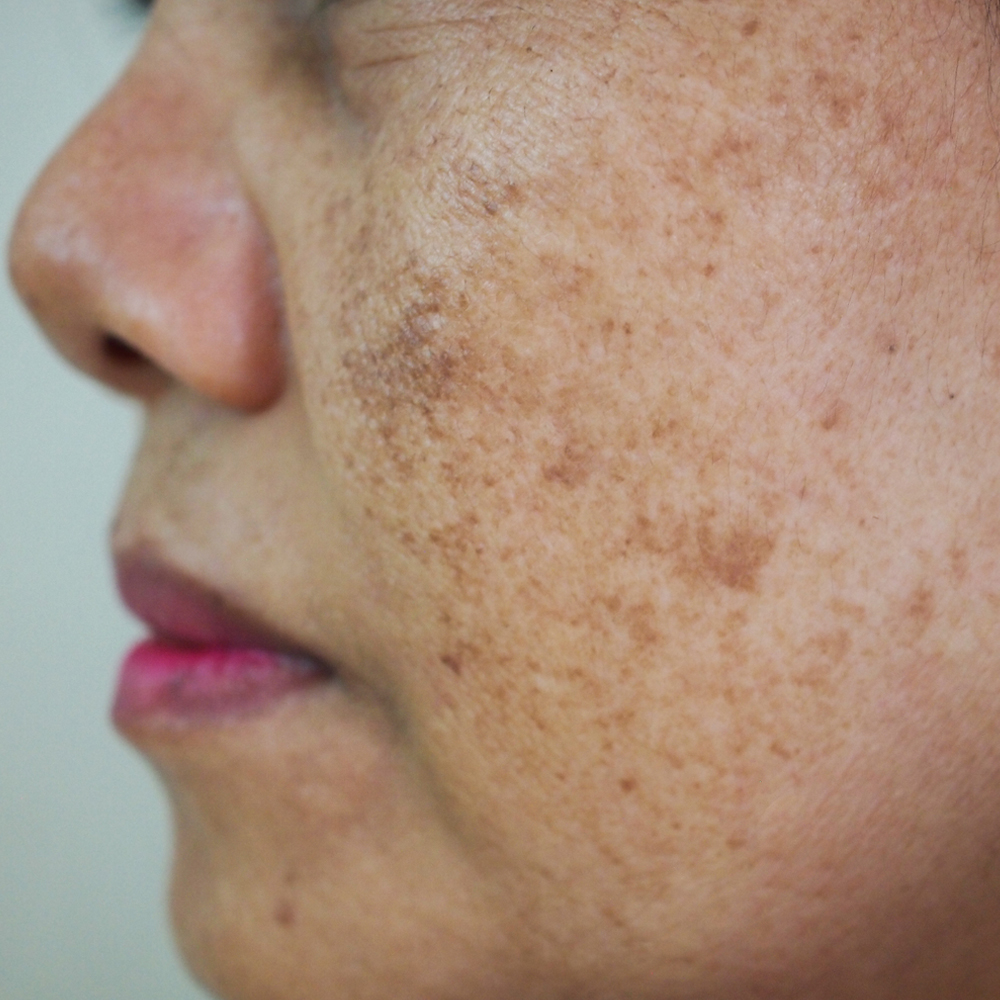 Melasma Treatment In Pune: Cost, Diagnosis & Procedure