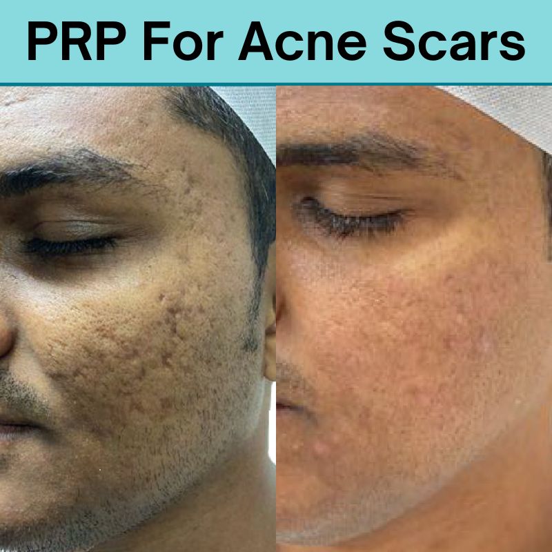 Boxcar Scars Treatments Results Prevention Boxcar Scars Treatments Results Prevention