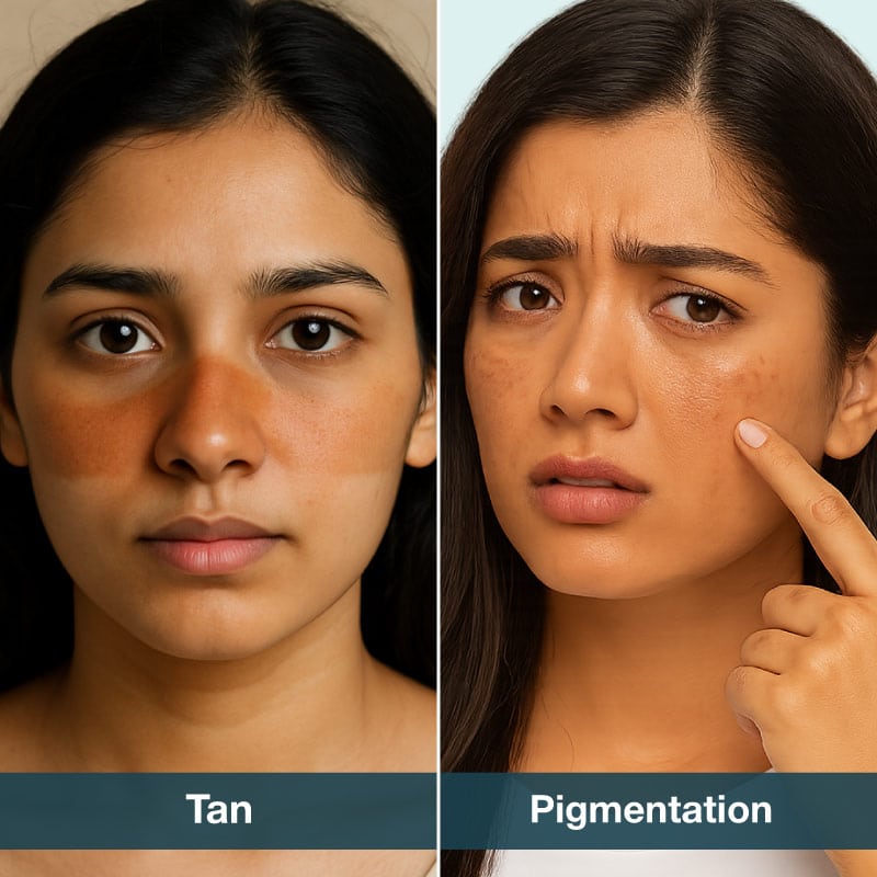 Difference Between Tan and Pigmentation: Causes, Signs & Treatments