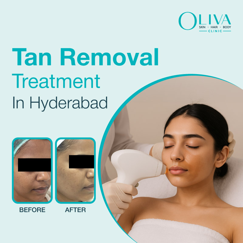 Tan Removal Treatment in Hyderabad: Cost, Results & Procedure