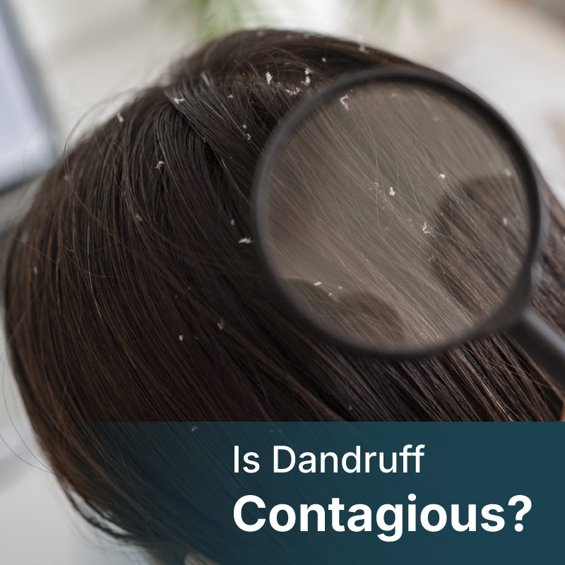 Is Dandruff Contagious? Here's Why No