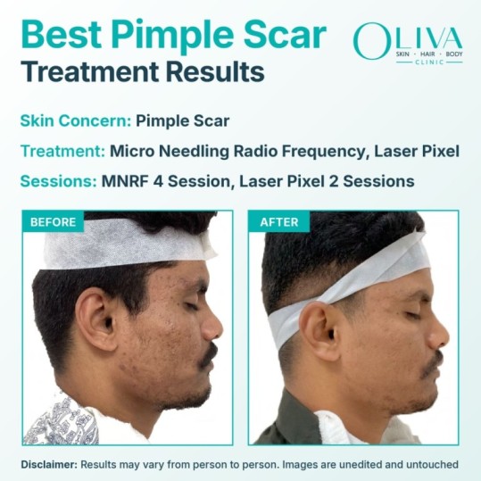 Best Pimple Scar Treatment: A Real Transformation Through Dermatologist ...